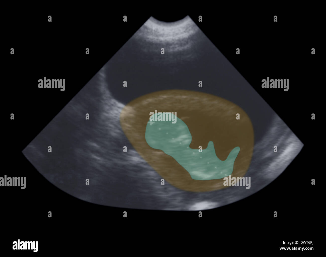 Chorion Placenta Stockfotos und -bilder Kaufen - Alamy