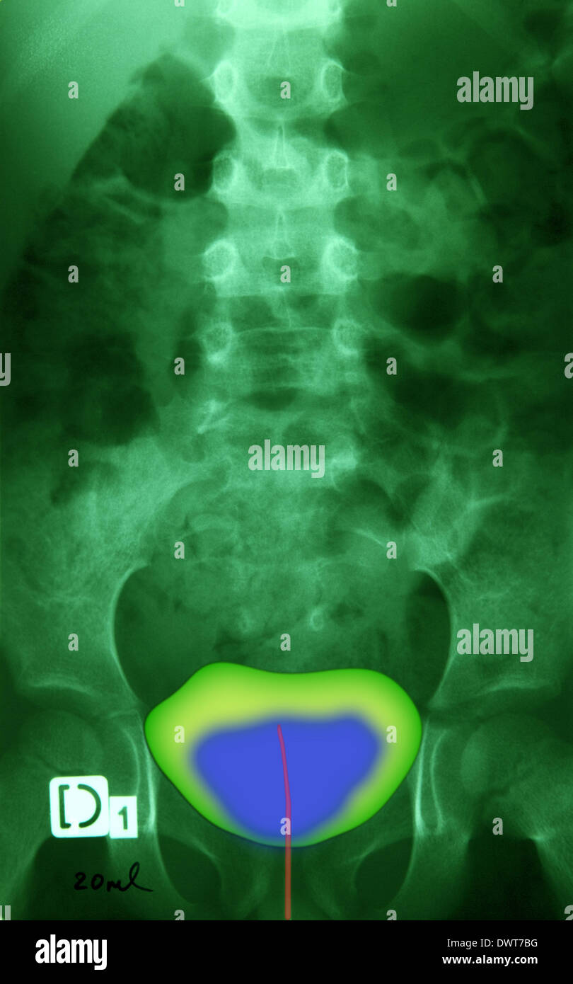 Retrograde zystographie -Fotos und -Bildmaterial in hoher Auflösung – Alamy