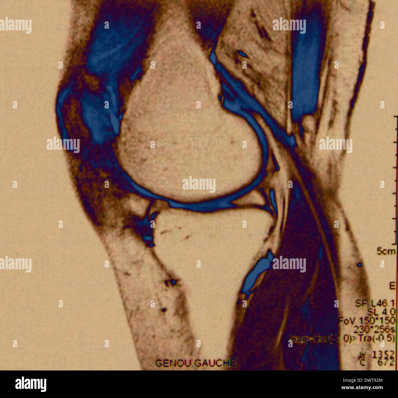 Knee Joint Mri Stockfotos & Knee Joint Mri Bilder - Alamy