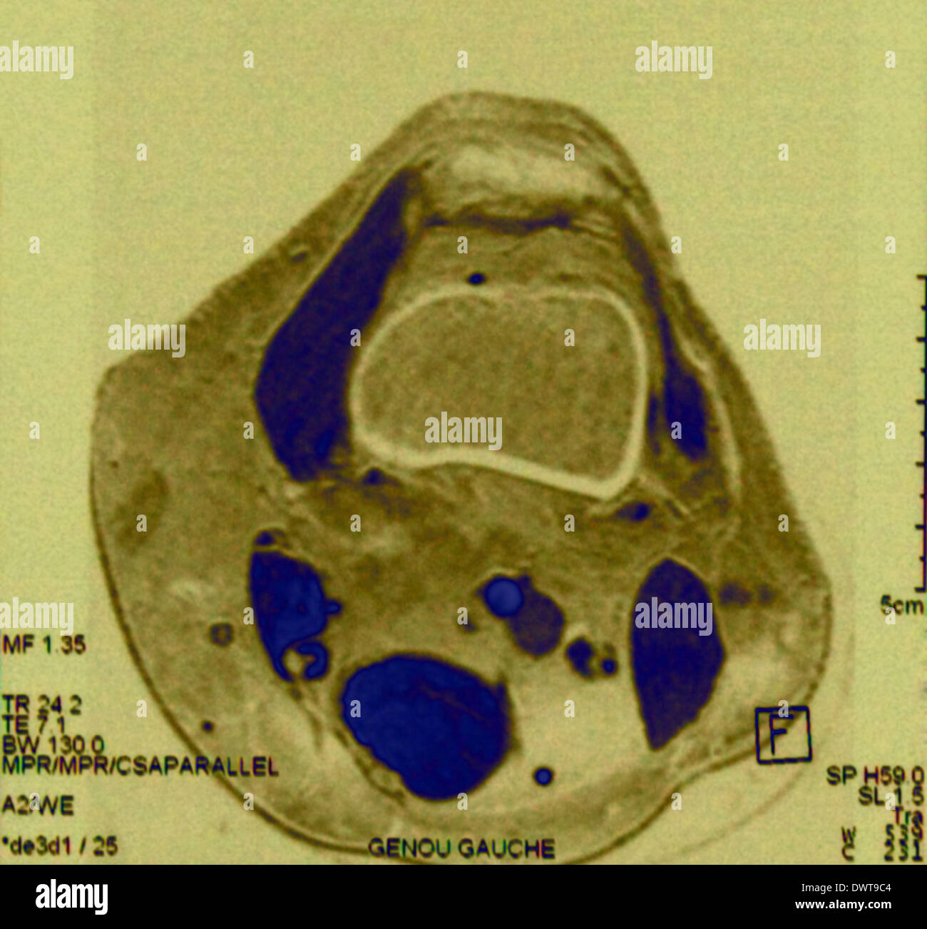 Musculus Biceps Femoris Stockfotos und -bilder Kaufen - Alamy