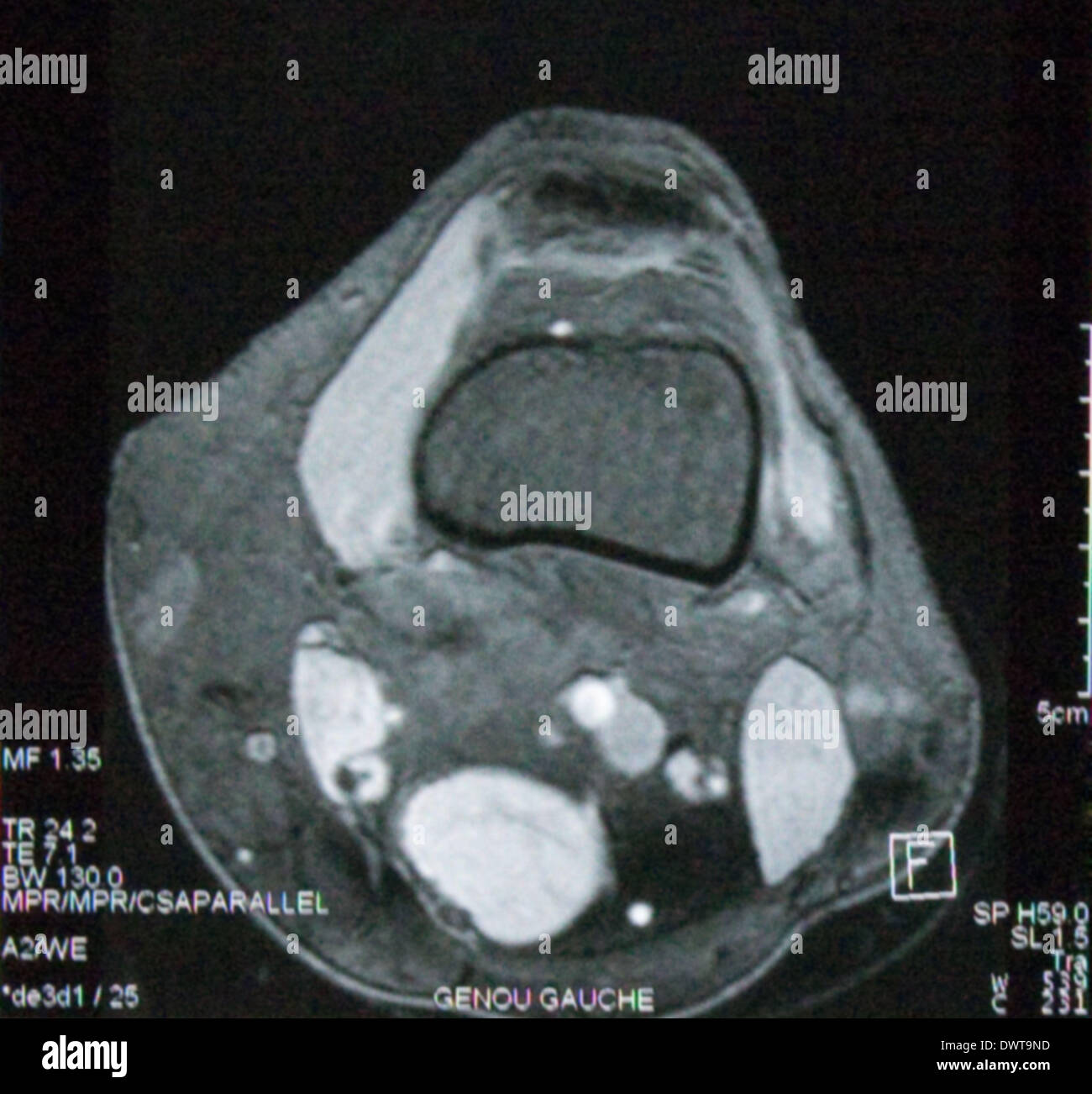 Musculus biceps femoris -Fotos und -Bildmaterial in hoher Auflösung – Alamy
