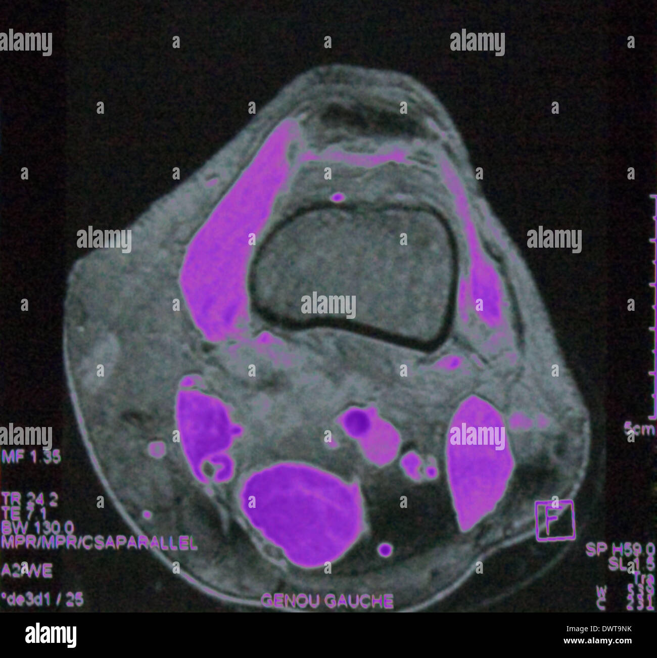 Musculus Biceps Femoris Stockfotos und -bilder Kaufen - Alamy