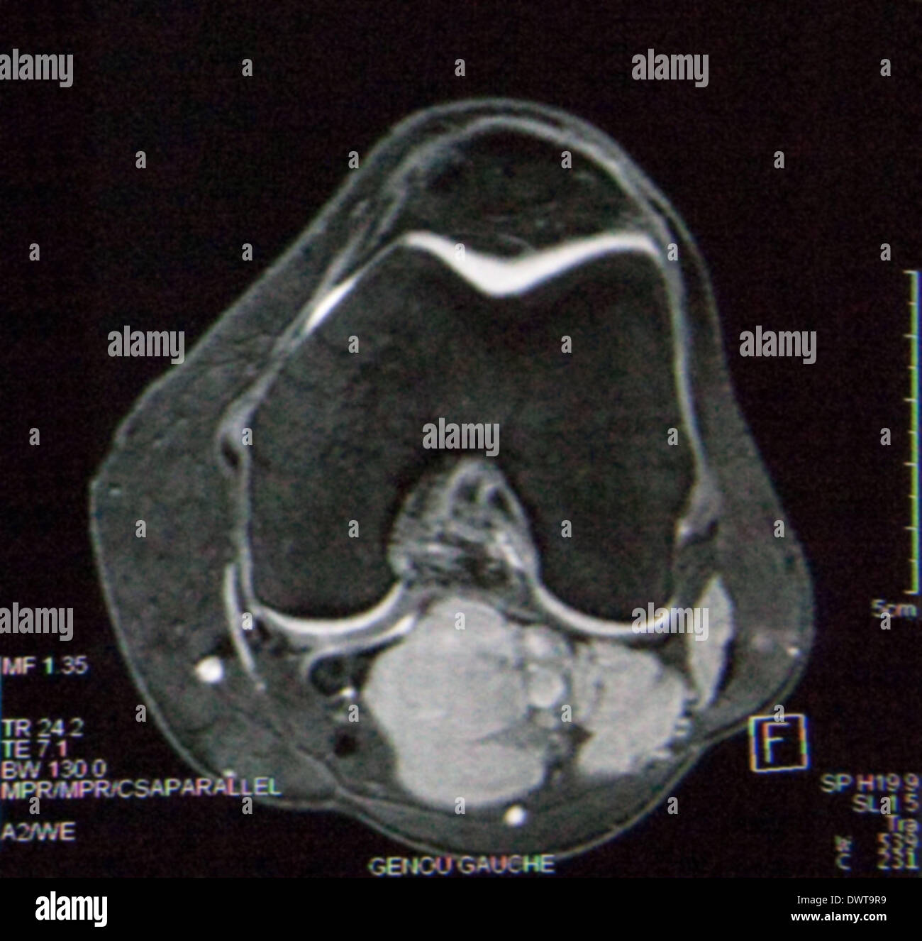 Musculus biceps femoris -Fotos und -Bildmaterial in hoher Auflösung – Alamy