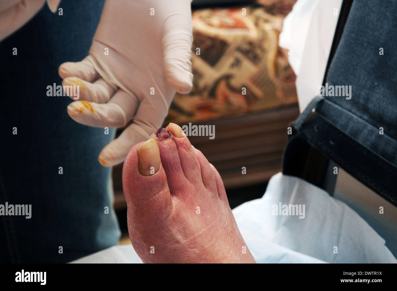 Necrosis foot -Fotos und -Bildmaterial in hoher Auflösung – Alamy