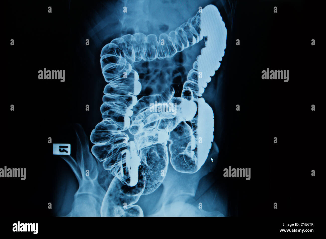 Normales rektum -Fotos und -Bildmaterial in hoher Auflösung – Alamy