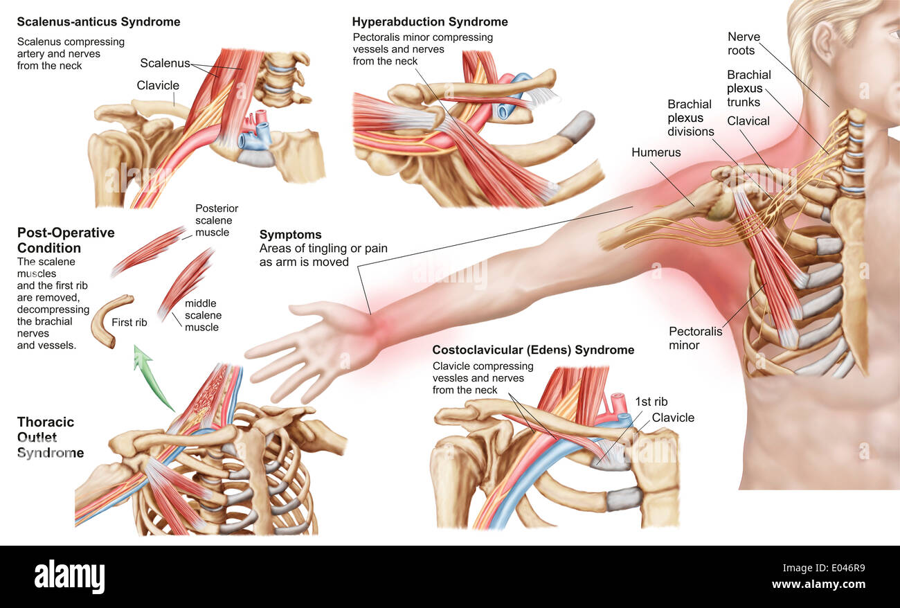 Thoracic Outlet Syndrom Symptome