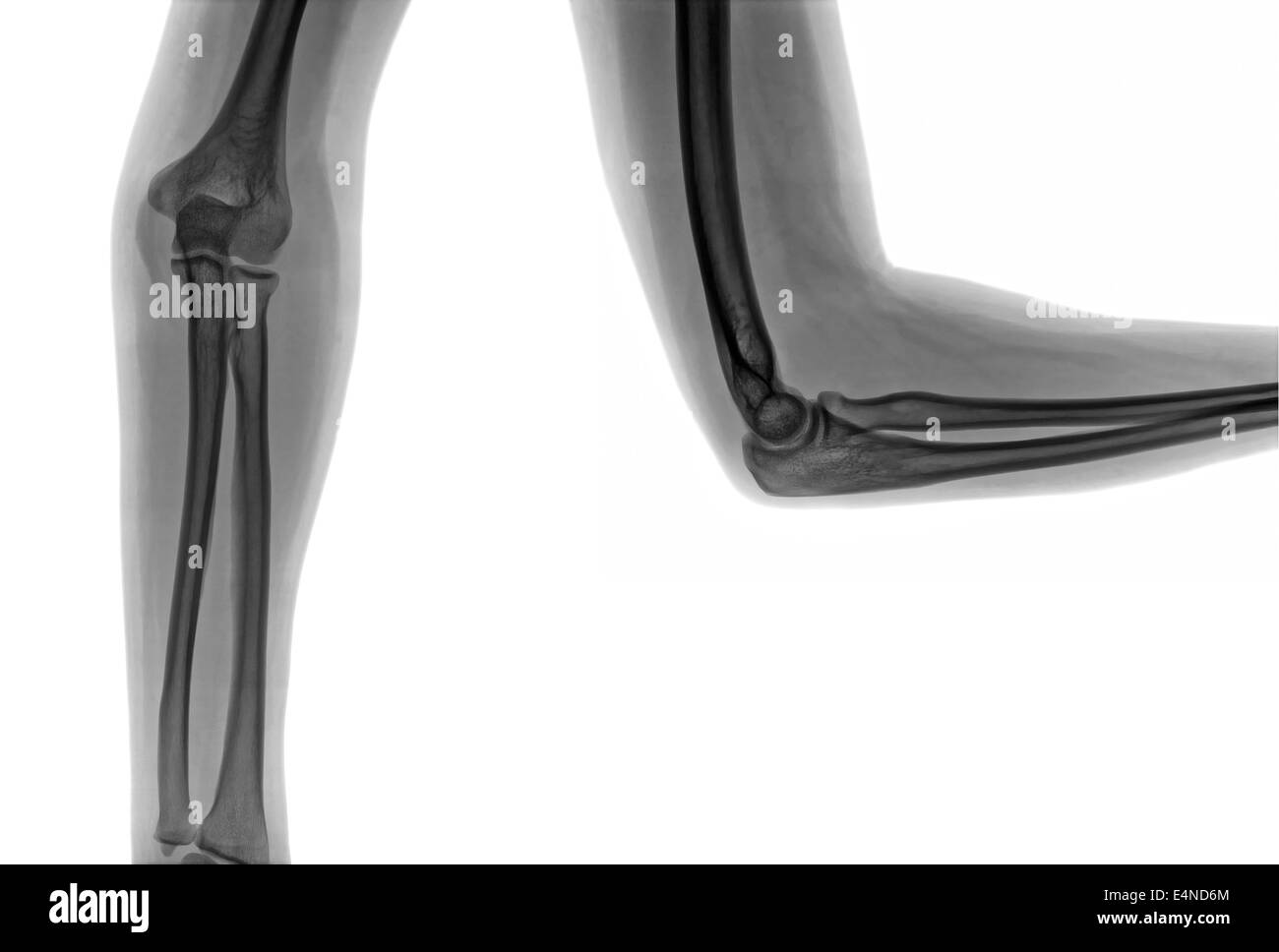 Ellbogen anatomie Schwarzweiß-Stockfotos und -bilder - Alamy