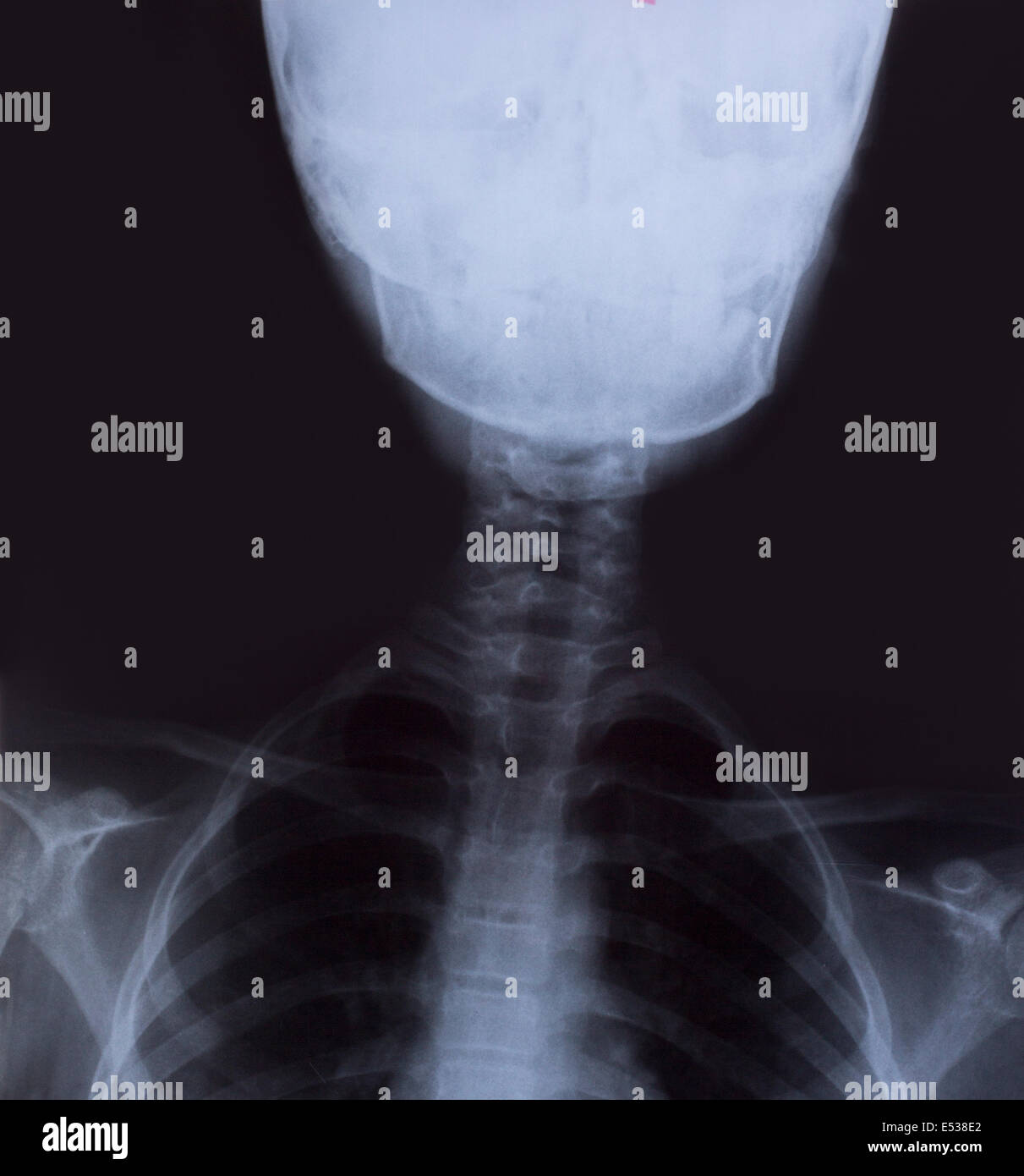 Kopf Röntgen Stockfotos & Kopf Röntgen Bilder - Alamy