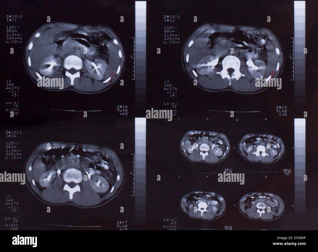 Chest ct scan -Fotos und -Bildmaterial in hoher Auflösung – Alamy