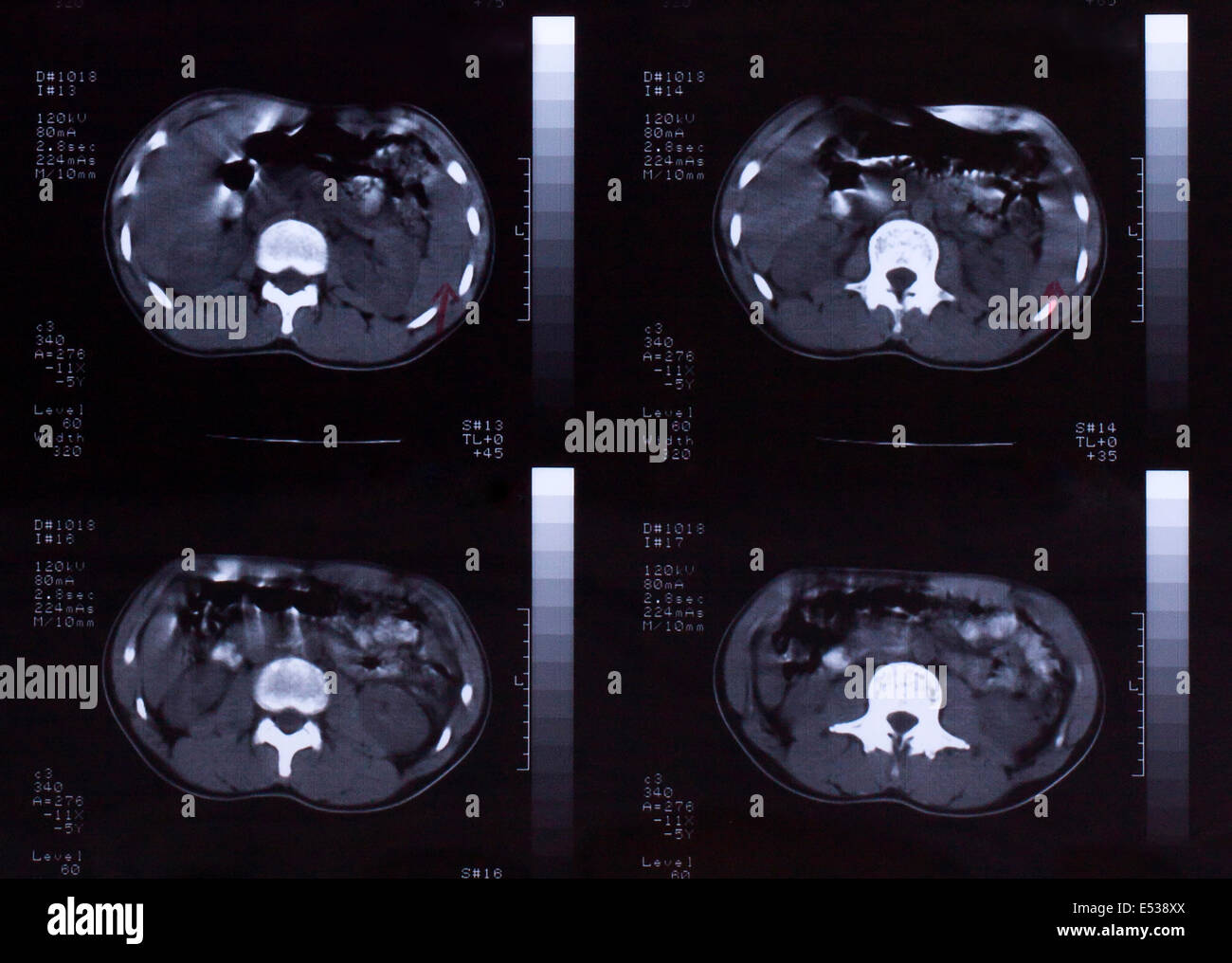 Ct Scan Abdomen Stockfotos und -bilder Kaufen - Alamy