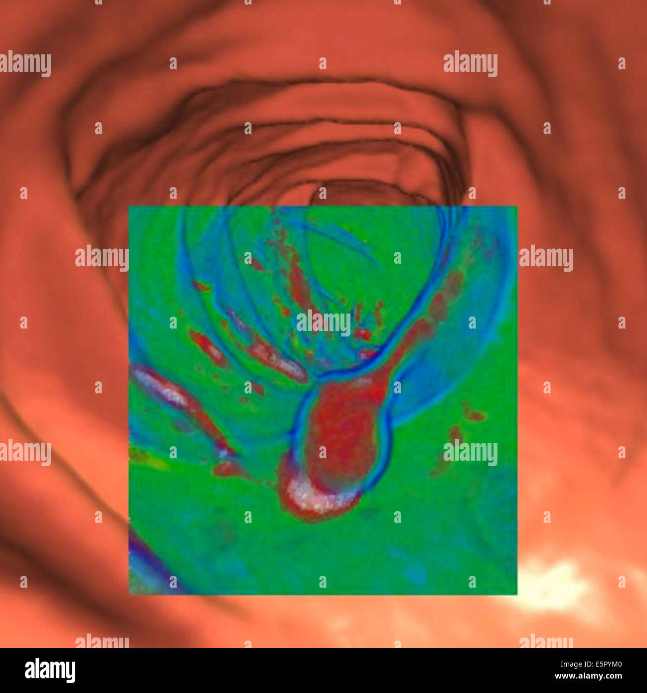 Ein 3D Computertomographie (CT)-Scan des Dickdarms, zeigt eine kleine ...