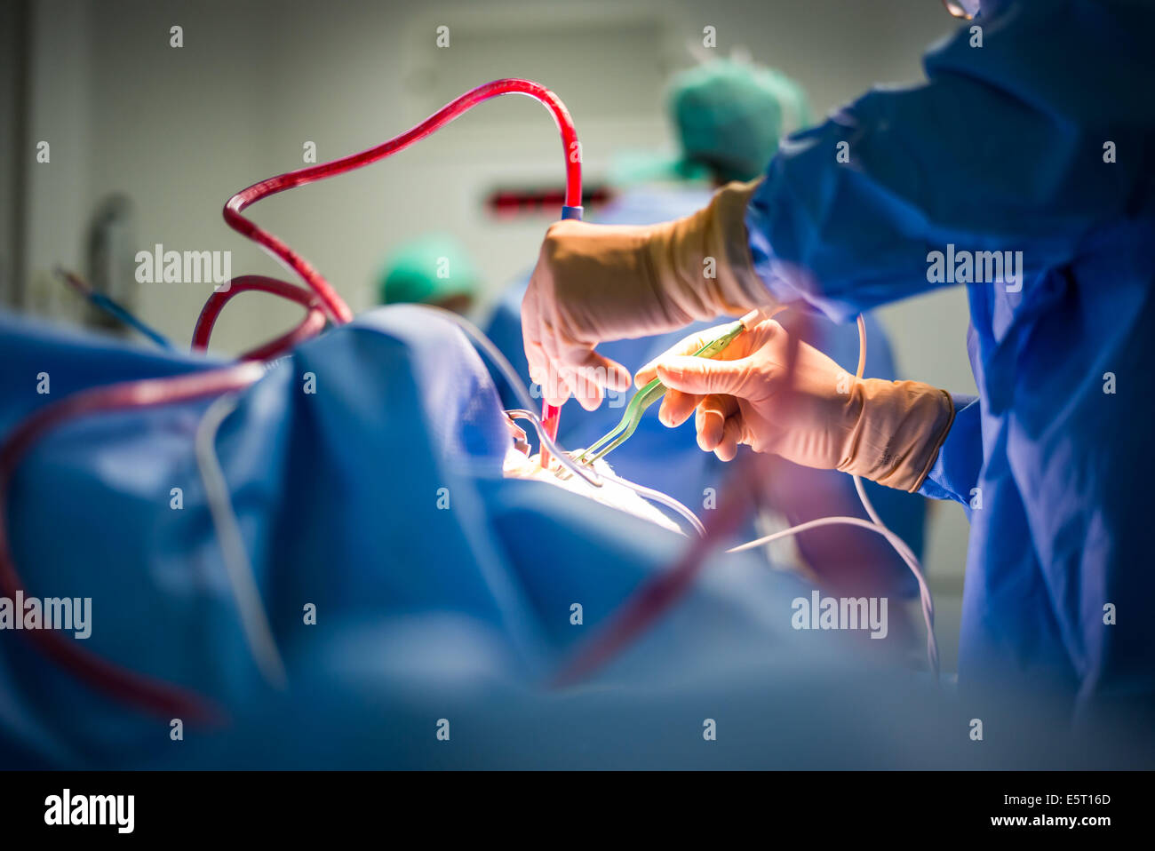 Behandlung von Schnarchen Tonsillektomie (Ablation der Mandeln), Foch ...