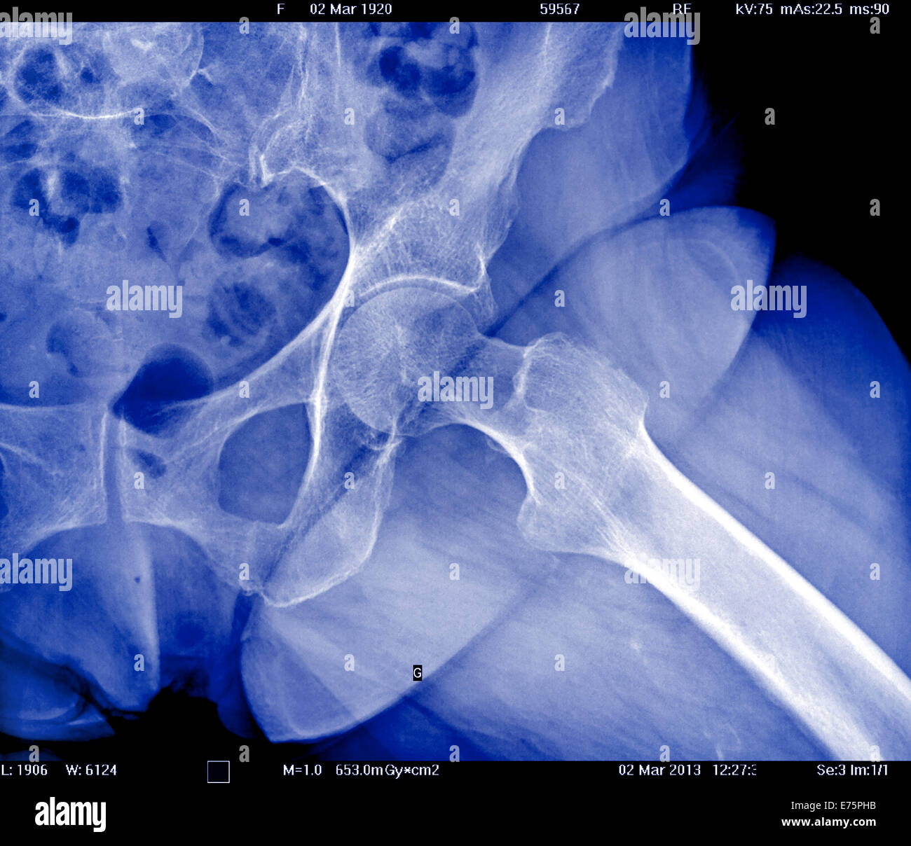 Pelvis bones femurs Stockfotos und -bilder Kaufen - Seite 2 - Alamy