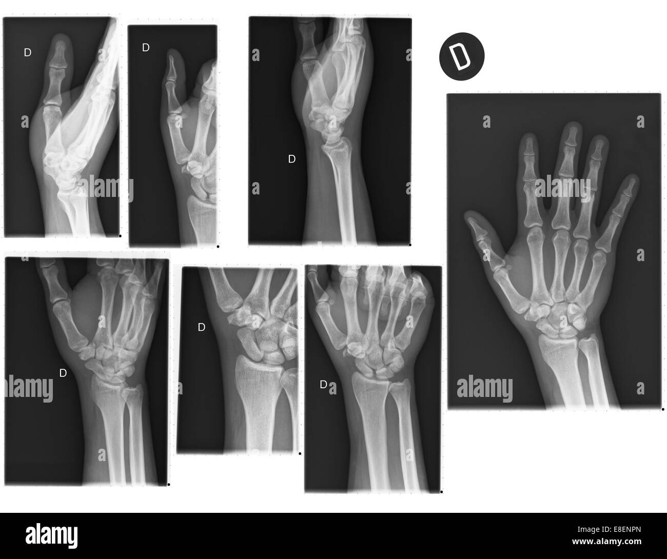 Echte Röntgenaufnahmen der Hand und des Handgelenks. (Handgelenkbruch ...