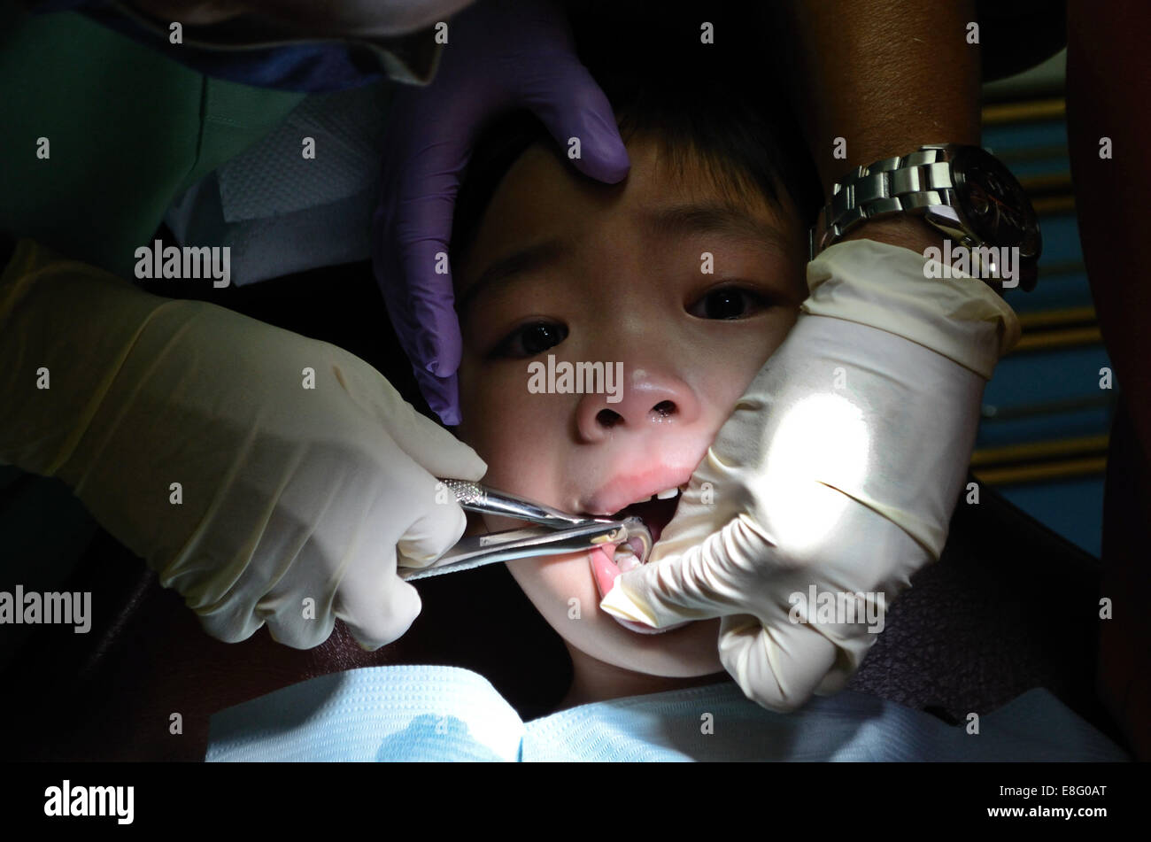 Extrahierender Zahn Stockfotos und -bilder Kaufen - Alamy