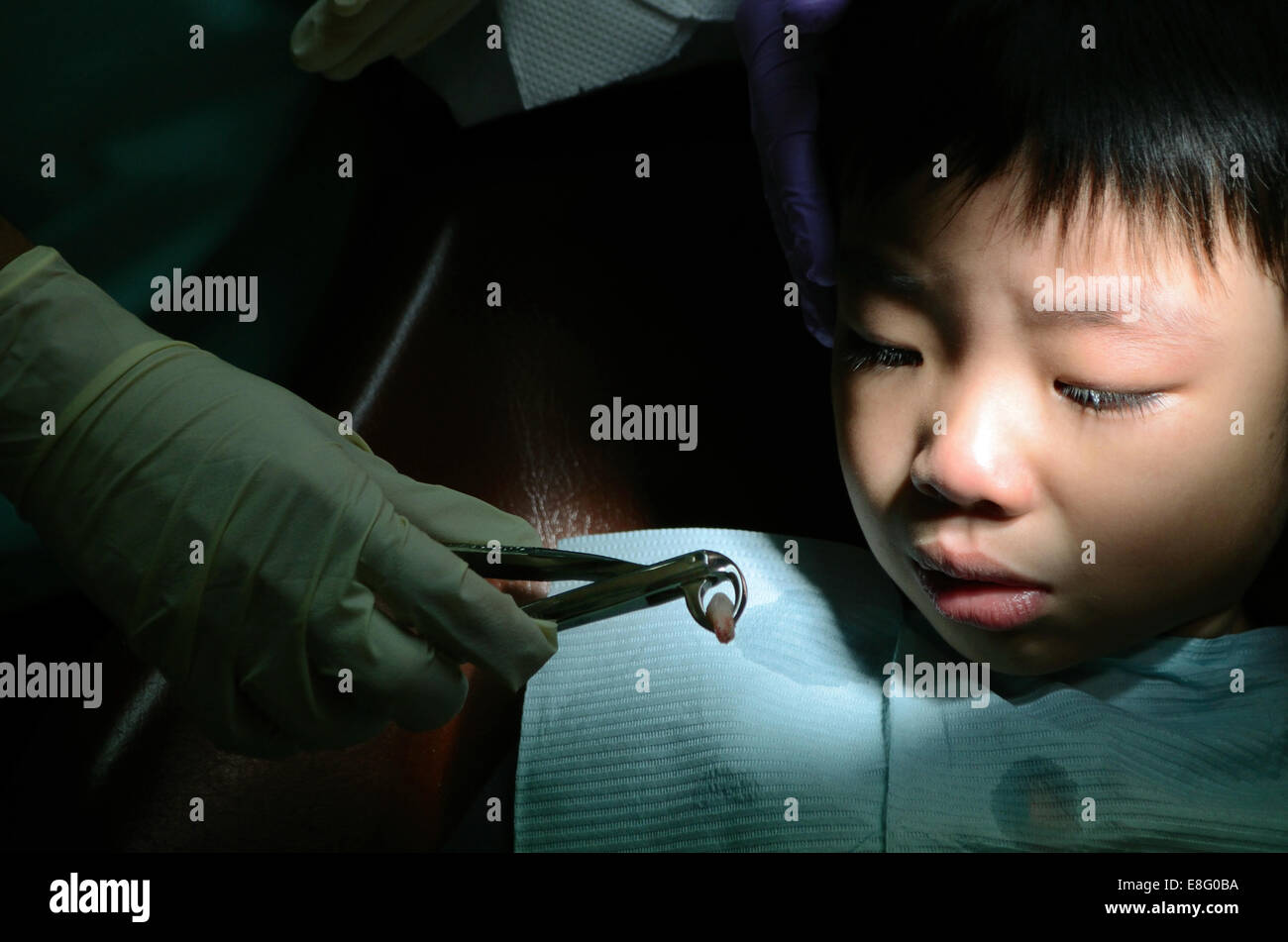 Extraction tooth Stockfotos und -bilder Kaufen - Alamy