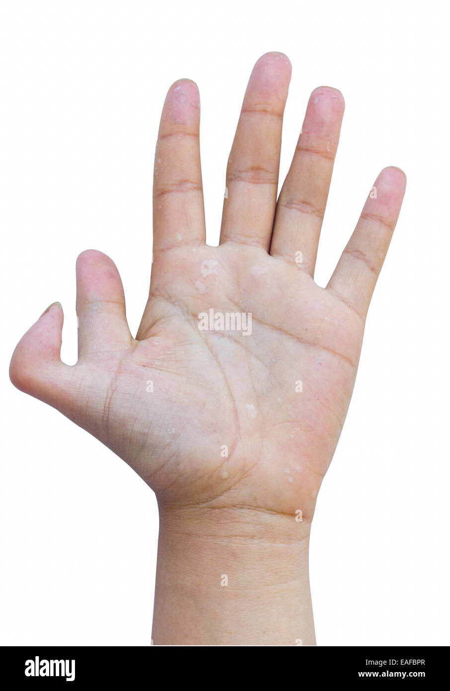 Sechs Finger Stockfotos und -bilder Kaufen - Alamy