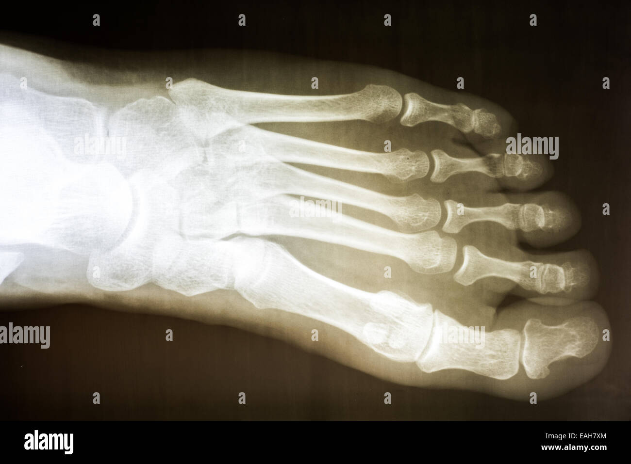 Transparent arthritis -Fotos und -Bildmaterial in hoher Auflösung – Alamy