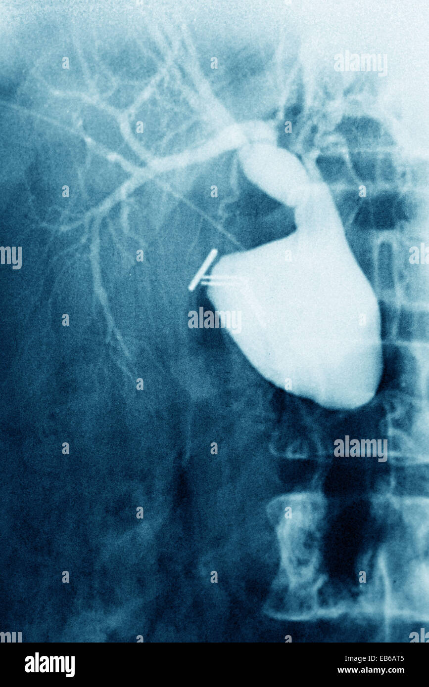 Ductus choledochus -Fotos und -Bildmaterial in hoher Auflösung – Alamy