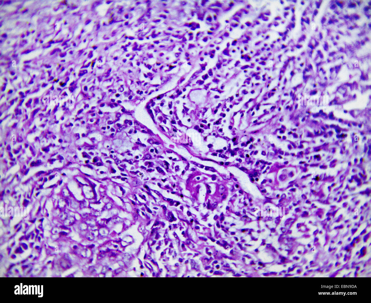Karzinom -Fotos und -Bildmaterial in hoher Auflösung – Alamy