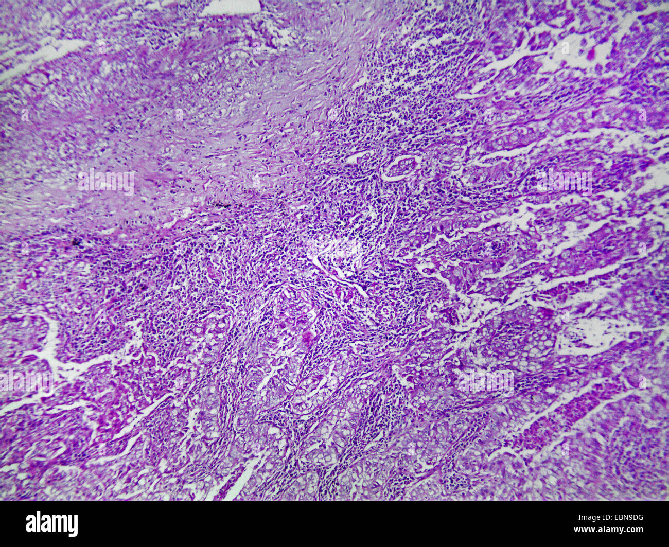 Histologie Lungenkarzinom : Lungenkarzinom, kleinzellig (SCLC ...