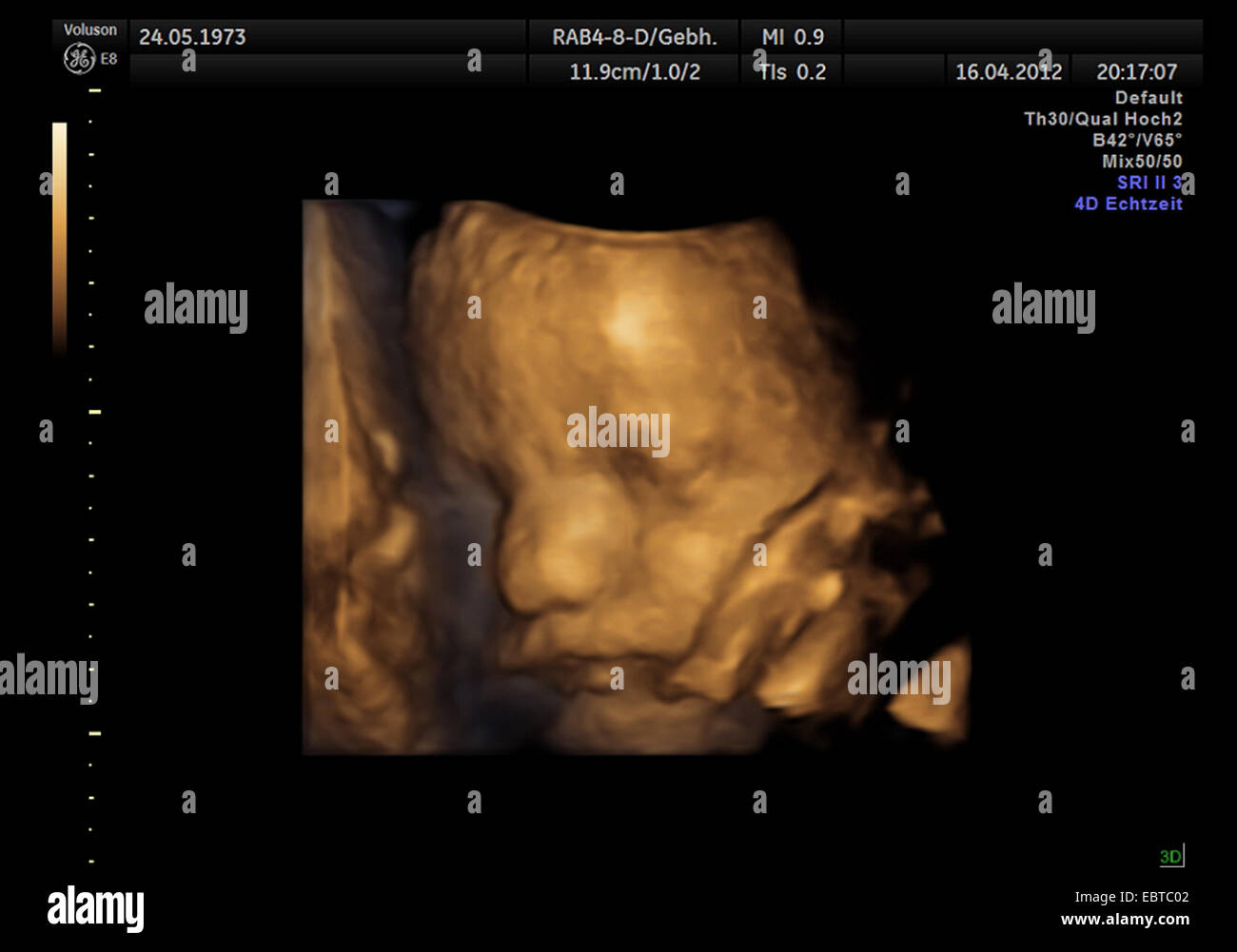 Embrión en el útero -Fotos und -Bildmaterial in hoher Auflösung – Alamy