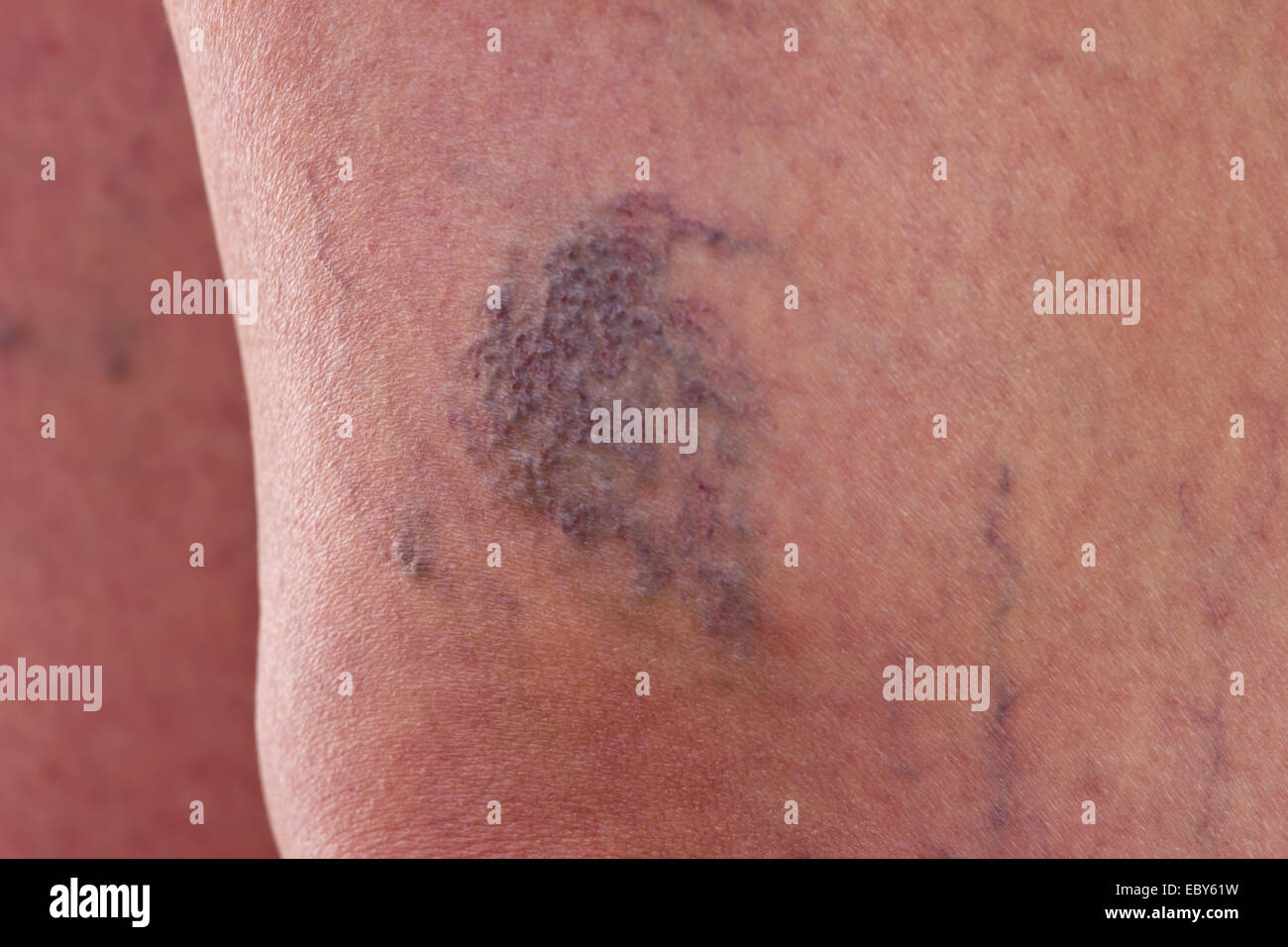 Thrombose bein -Fotos und -Bildmaterial in hoher Auflösung - Seite 2 ...