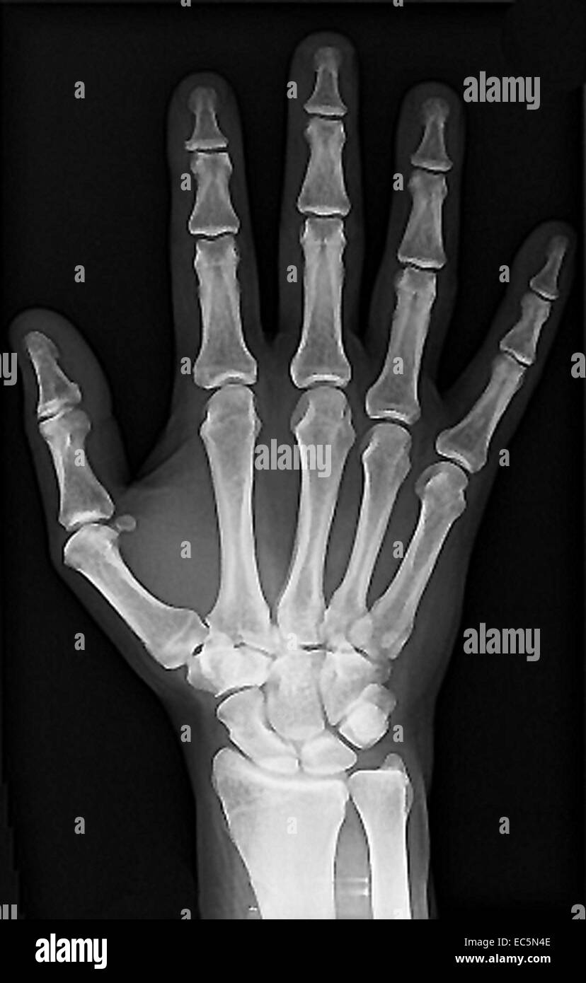 Roentgen hand -Fotos und -Bildmaterial in hoher Auflösung – Alamy