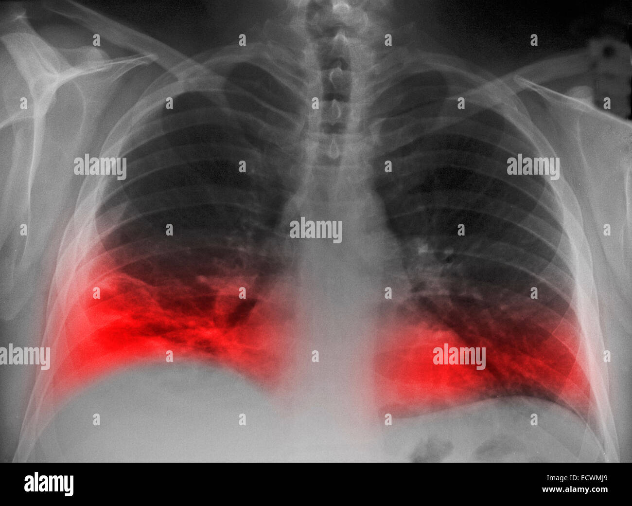 X Ray Chest Showing Pneumonia Stockfotos und -bilder Kaufen - Alamy