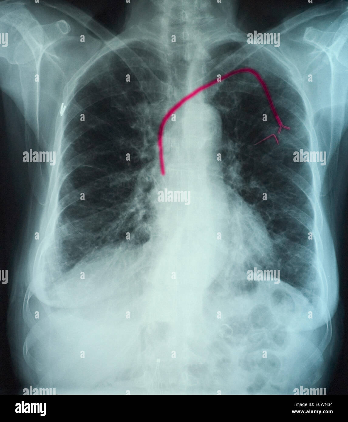 Picc line cancer -Fotos und -Bildmaterial in hoher Auflösung – Alamy