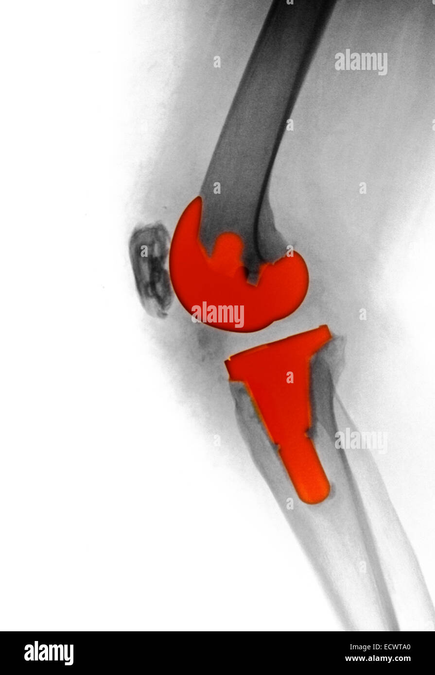 Knee Replacement Stockfotos & Knee Replacement Bilder - Alamy
