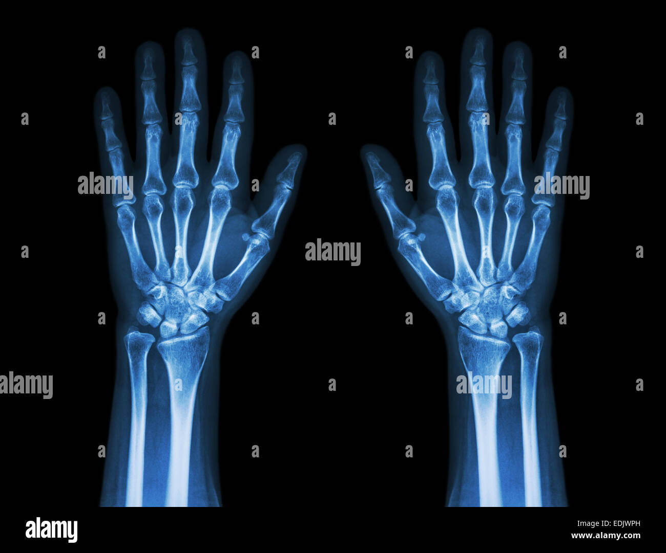 Xray hand normal -Fotos und -Bildmaterial in hoher Auflösung – Alamy