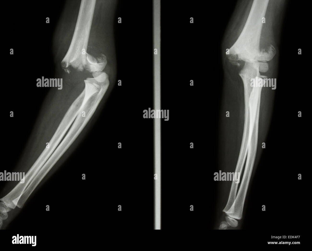 Film Röntgen Ellenbogen zeigen Supracondylar Humerus Fraktur ...