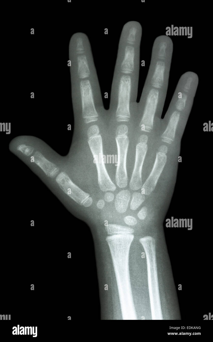 Normal X Ray The Hand Stockfotos und -bilder Kaufen - Alamy