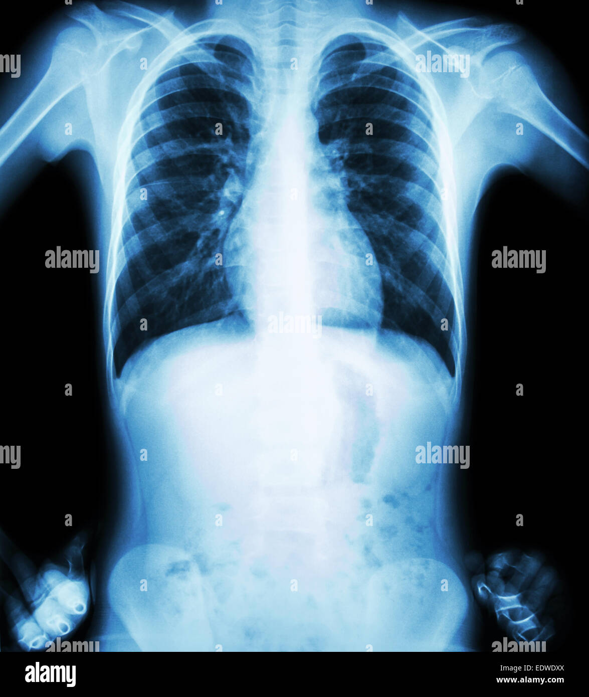 X-ray Brust (angewinkelten Position) (Frontansicht Stockfotografie - Alamy