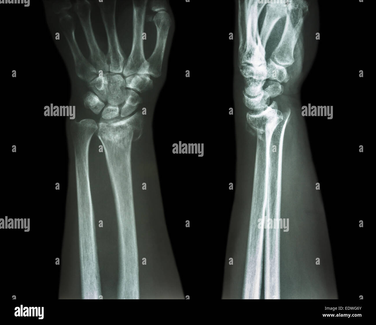 distale Radius Fraktur (Colles Fraktur) (Handgelenk gebrochen Stockfoto ...