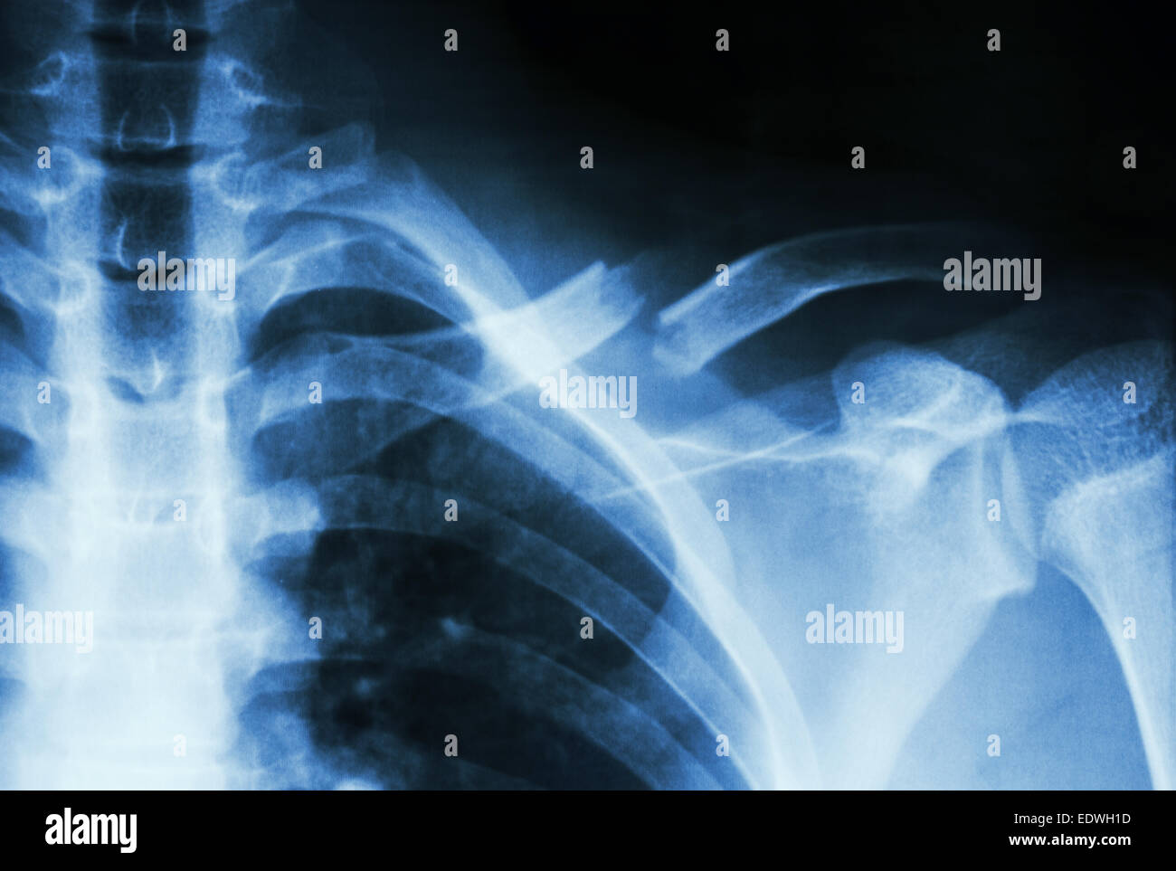 Gebrochene rippe -Fotos und -Bildmaterial in hoher Auflösung – Alamy