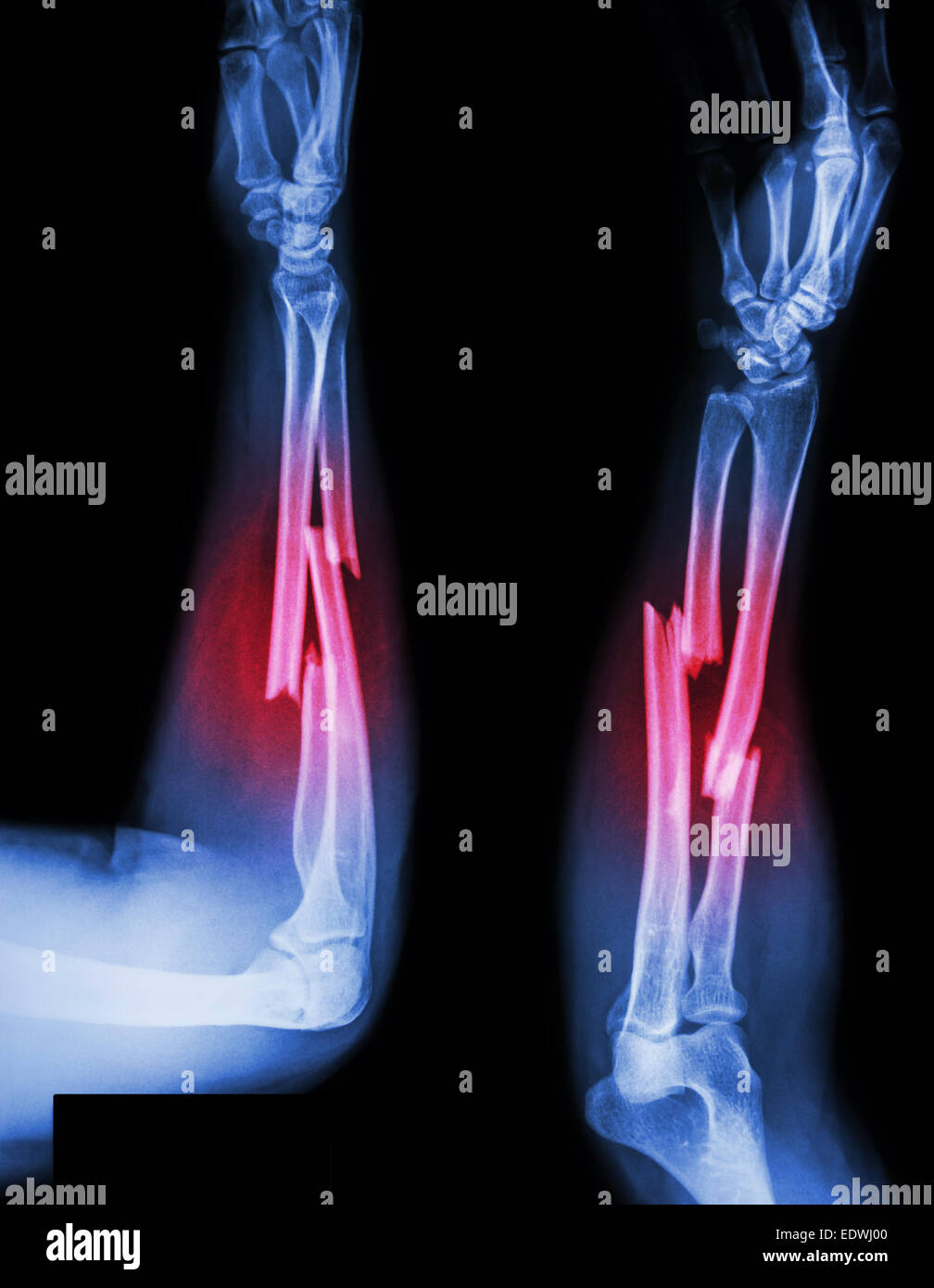 Anatomie du radius -Fotos und -Bildmaterial in hoher Auflösung – Alamy