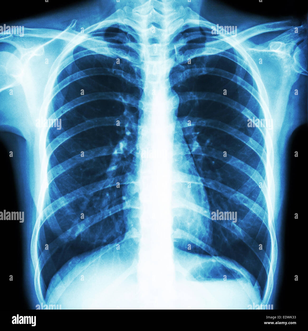 Normal lungs x ray -Fotos und -Bildmaterial in hoher Auflösung – Alamy