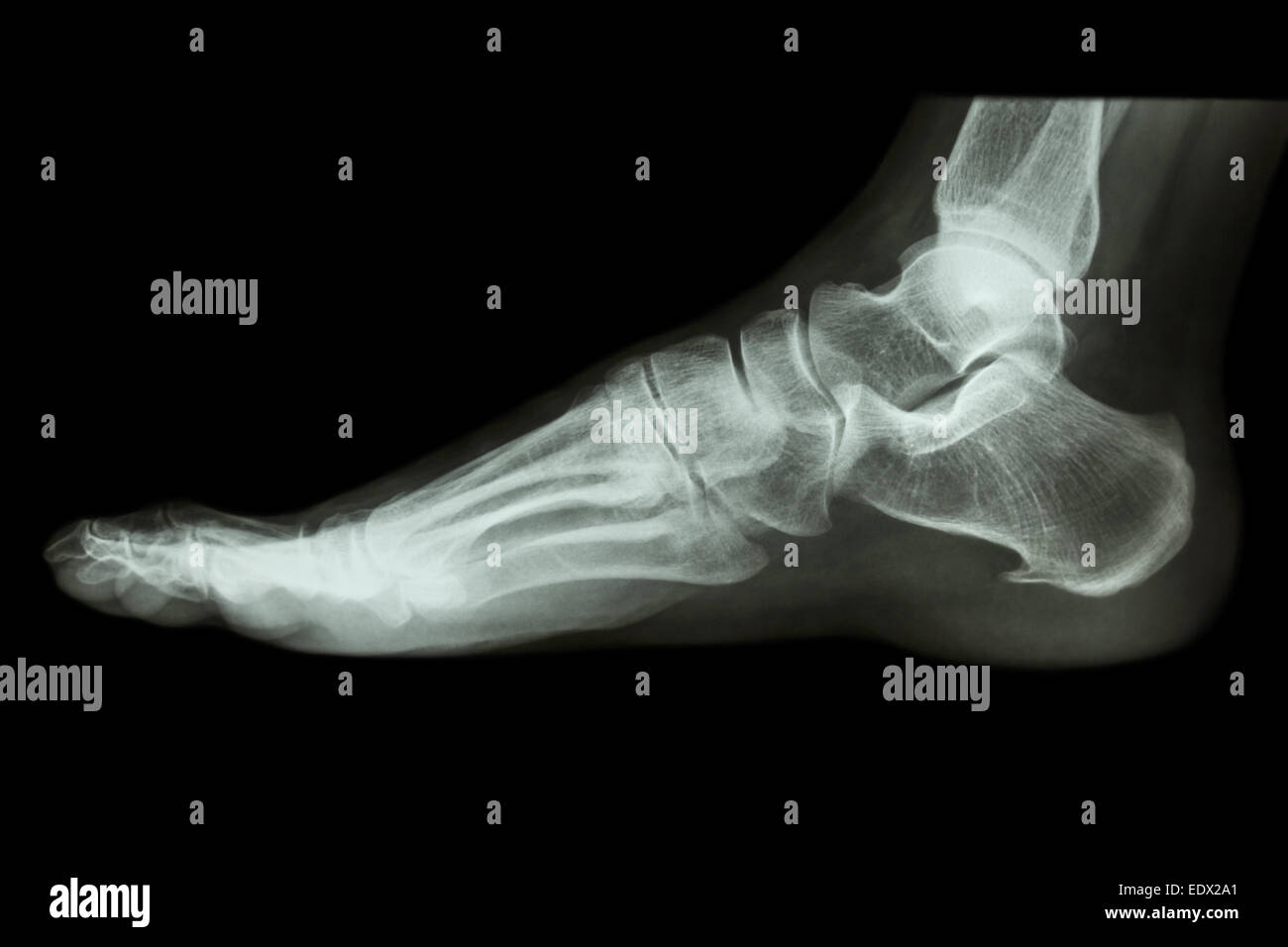 X-ray normal menschlichen Fuß seitlich Stockfotografie - Alamy
