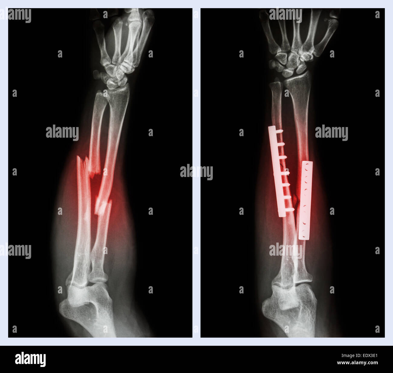 Forearm arm elbow injury xray -Fotos und -Bildmaterial in hoher ...