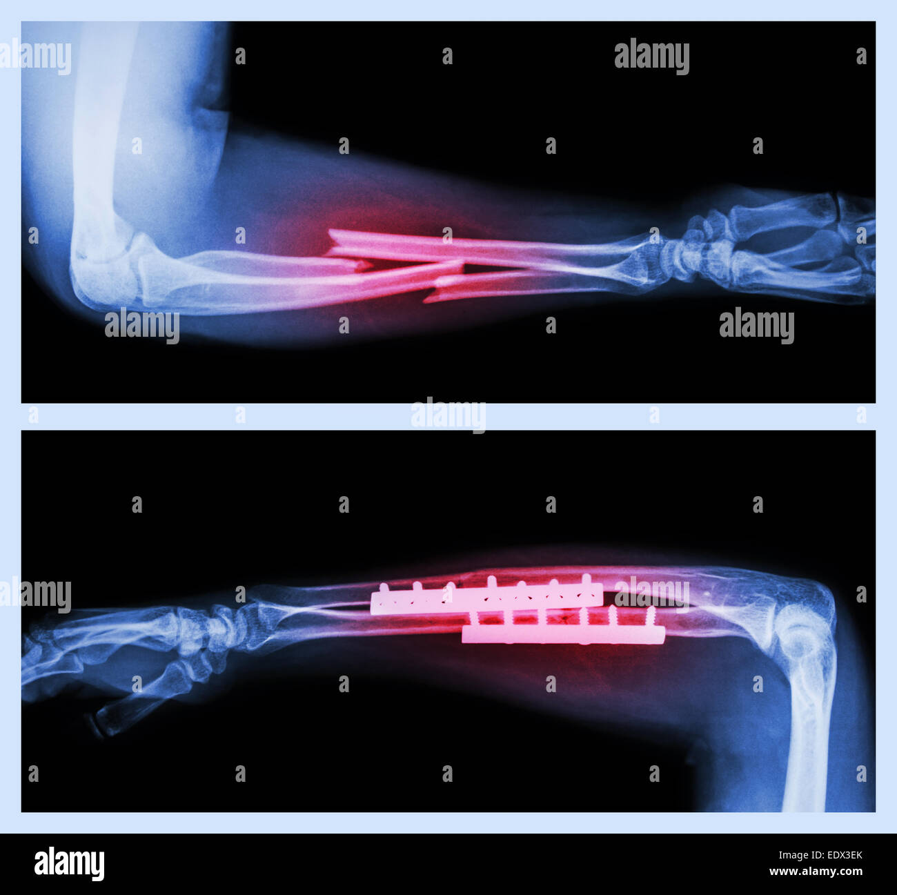 Fracture arm x ray -Fotos und -Bildmaterial in hoher Auflösung - Seite ...