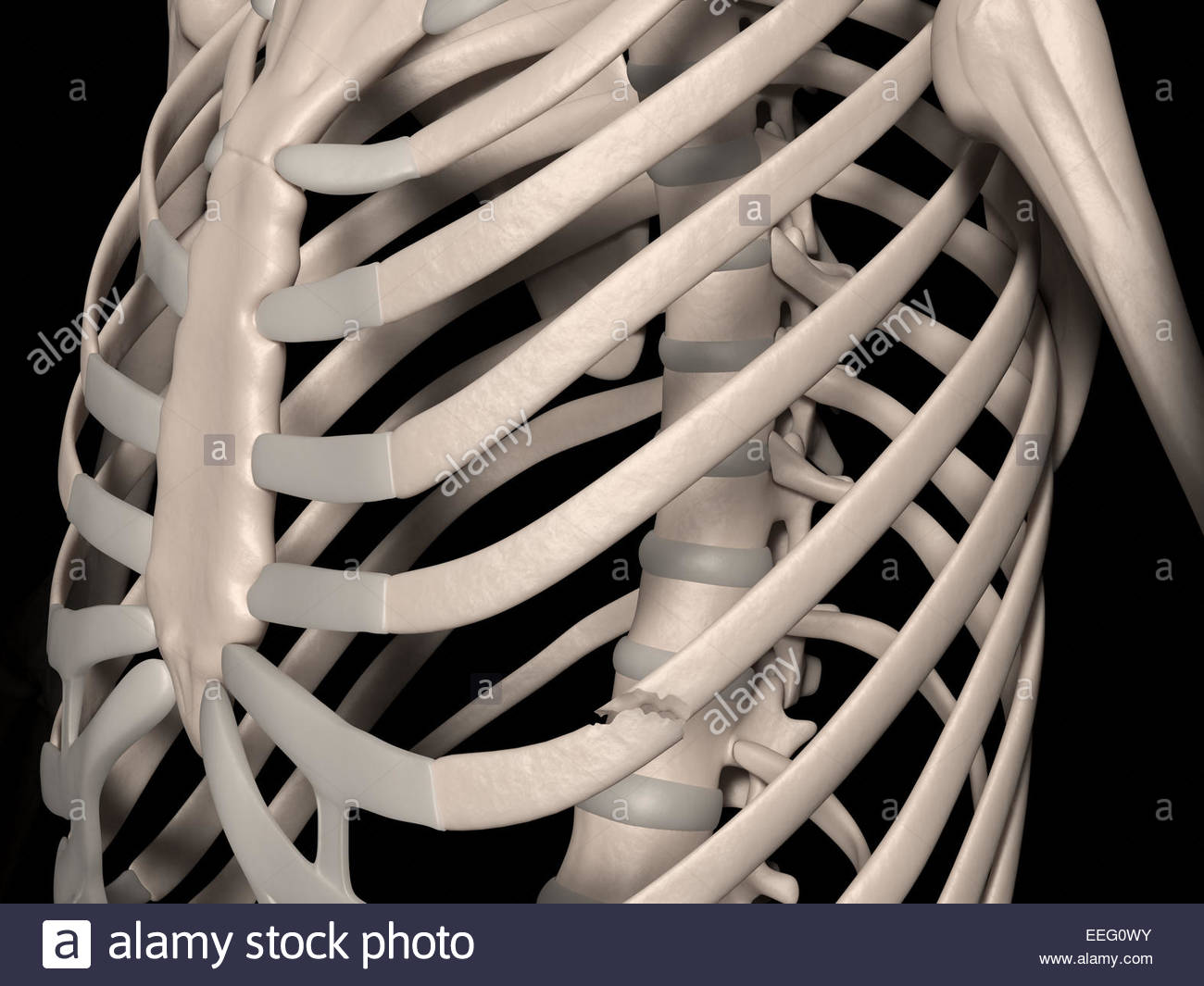 Gebrochene Rippe Stockfotos und -bilder Kaufen - Alamy