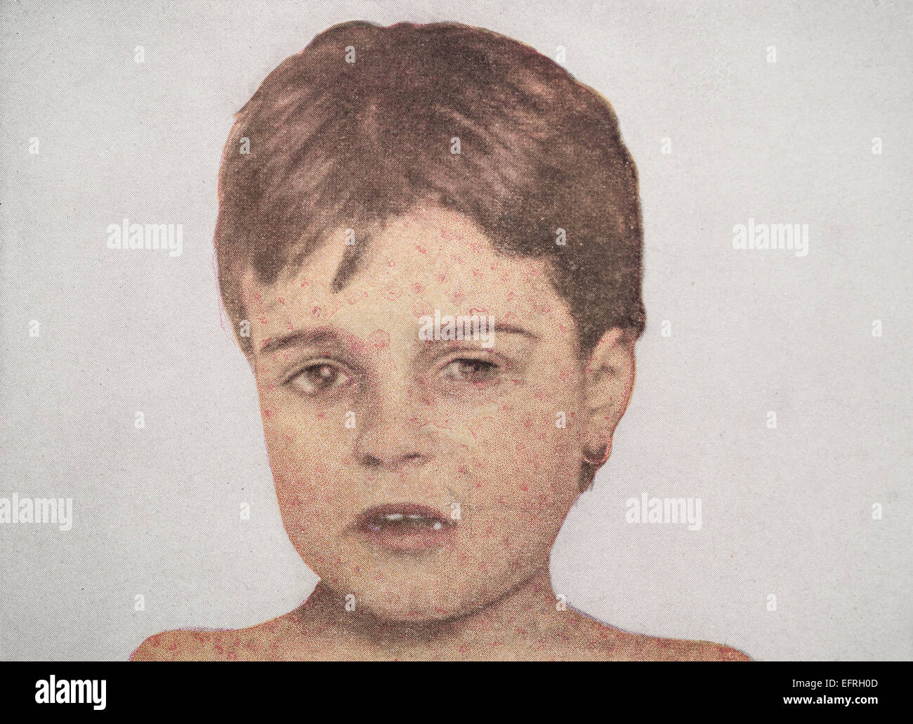 Kind mit Masern, ca. 1912 Stockfotografie - Alamy