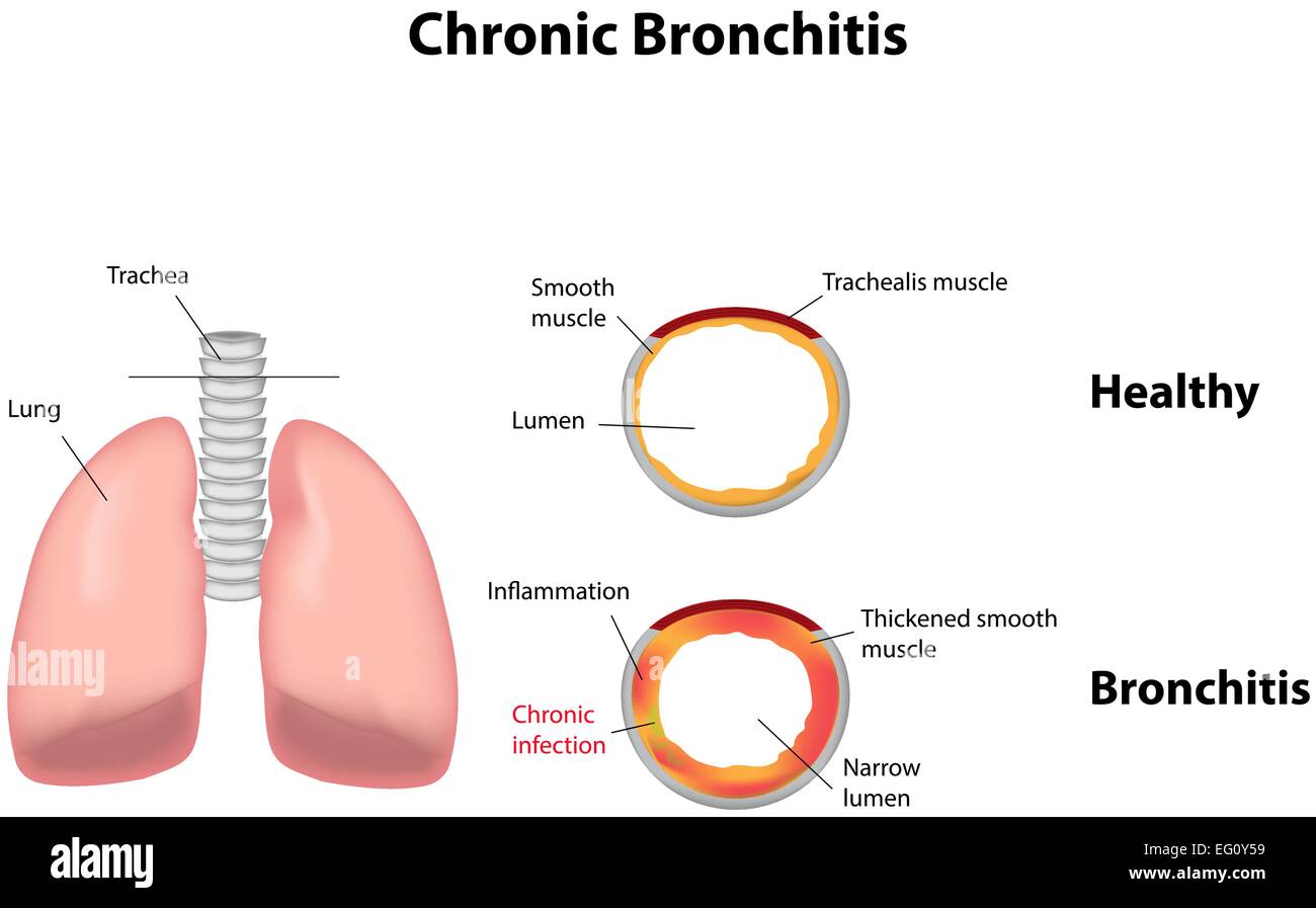 Wunderbar Chronische Bronchitis Ansteckend Fotos