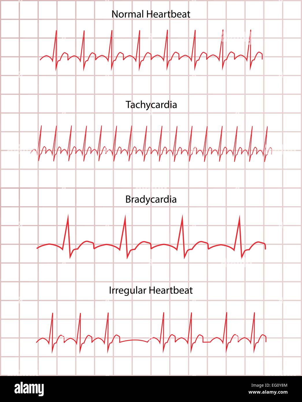 ECG EKG Pathologie Stock-Vektorgrafik - Alamy