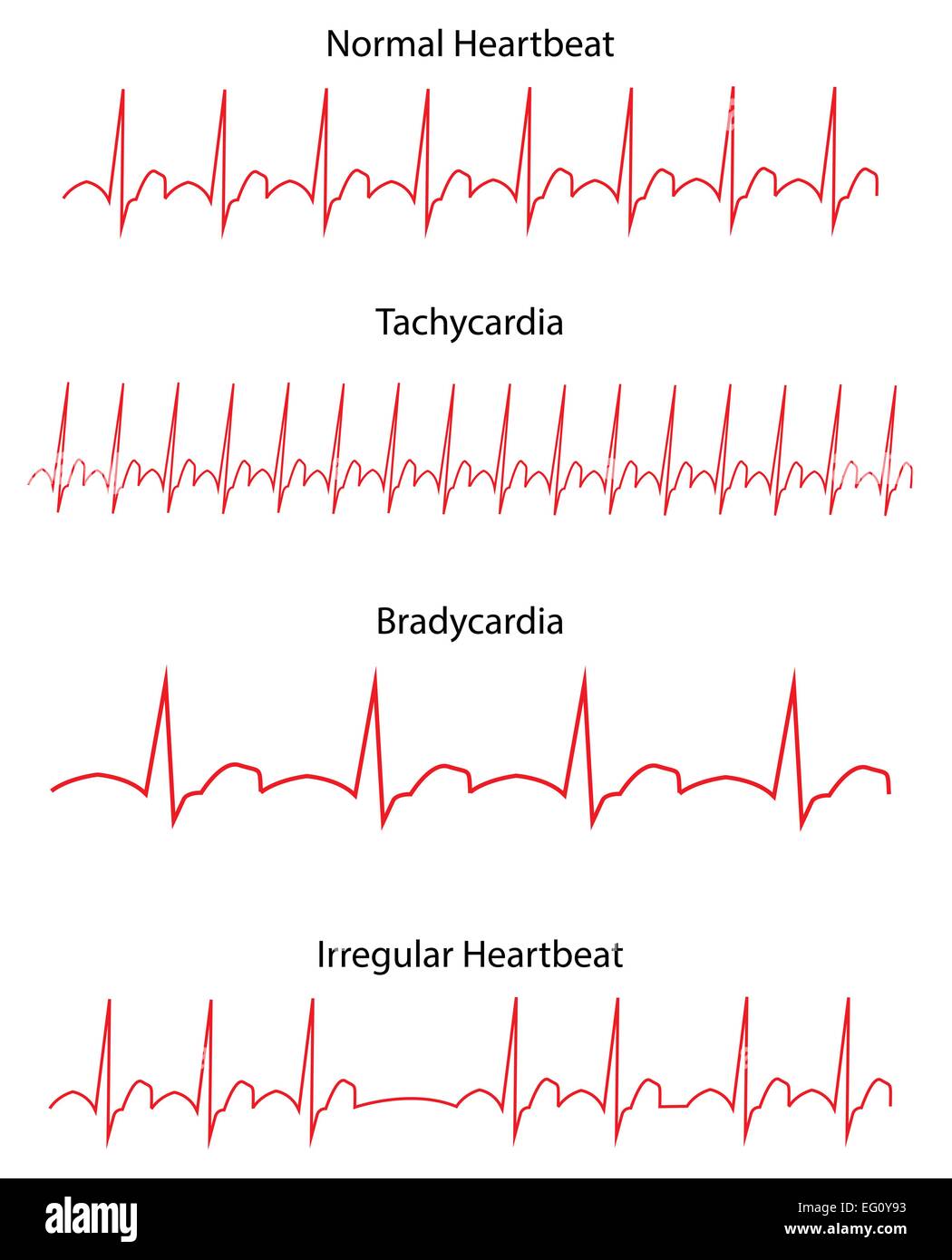 EKG Normal und Krankheit Stock-Vektorgrafik - Alamy