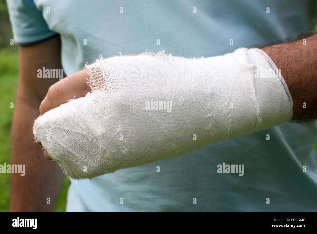 Hand Fracture Stockfotos & Hand Fracture Bilder - Seite 3 - Alamy