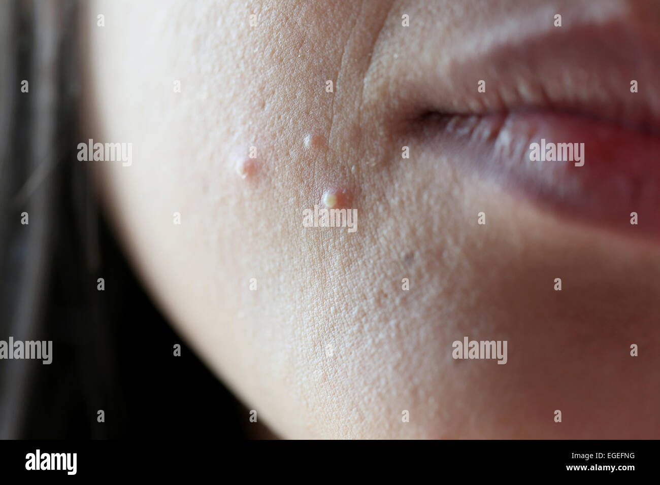 Akne hygiene -Fotos und -Bildmaterial in hoher Auflösung – Alamy