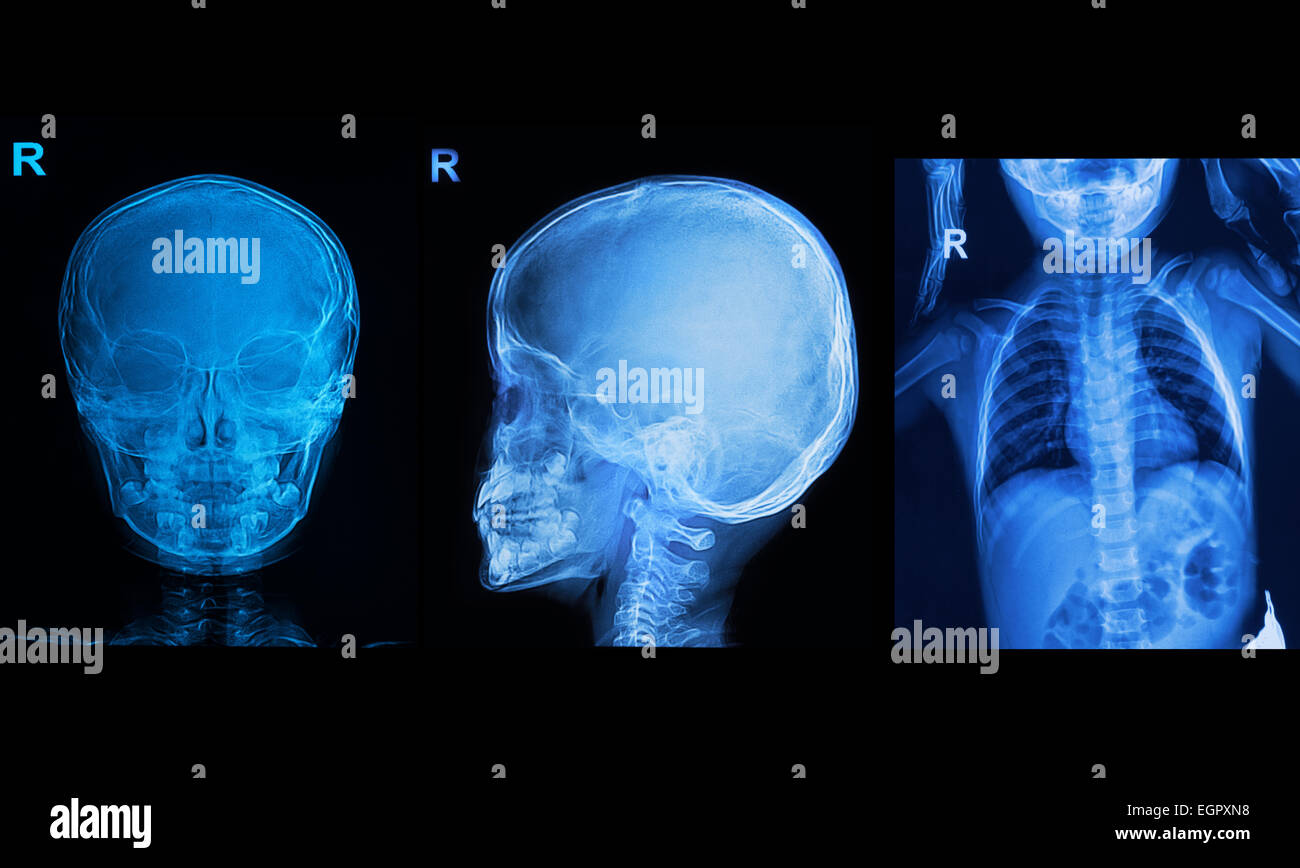 Child hand x ray -Fotos und -Bildmaterial in hoher Auflösung – Alamy